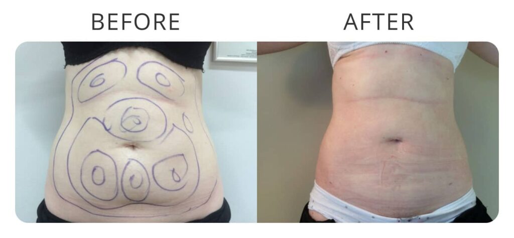 Legs, Chest & Abdomen & Liposuction for Arms in Slough